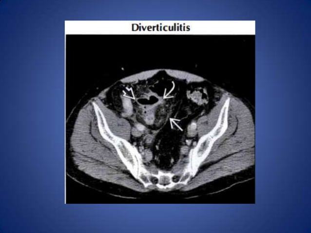 ACUTE LEFT LOWER QUADRANT PAIN | PDF