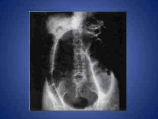 ACUTE LEFT LOWER QUADRANT PAIN | PPT