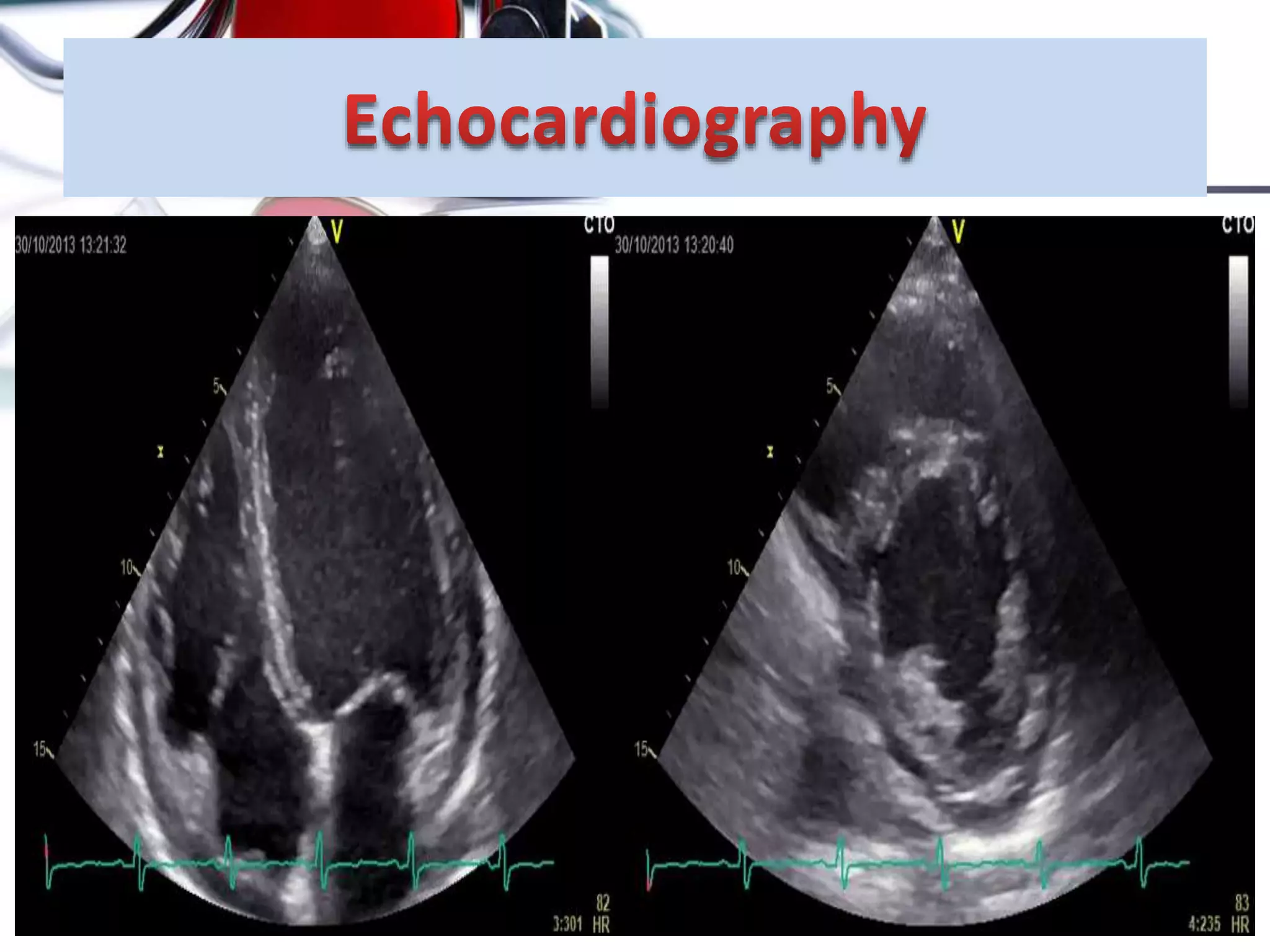 Acute left ventricular failure | PPTX