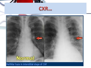Acute left ventricular failure | PPTX
