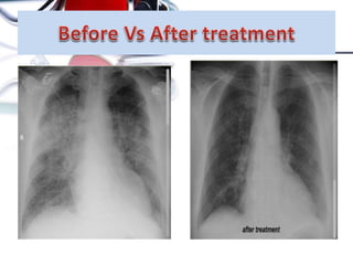 Acute left ventricular failure | PPTX