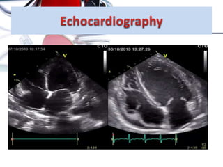 Acute left ventricular failure | PPTX