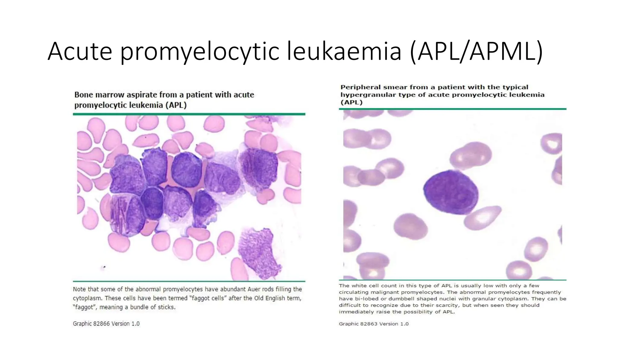 Acute Leukaemia - Most common leukaemia in adults | PPTX | Blood Disorders | Diseases and Conditions