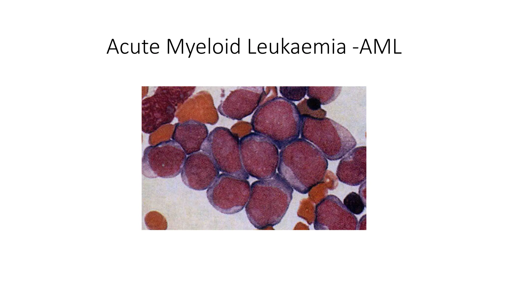 Acute Leukaemia - Most common leukaemia in adults | PPTX | Blood Disorders | Diseases and Conditions