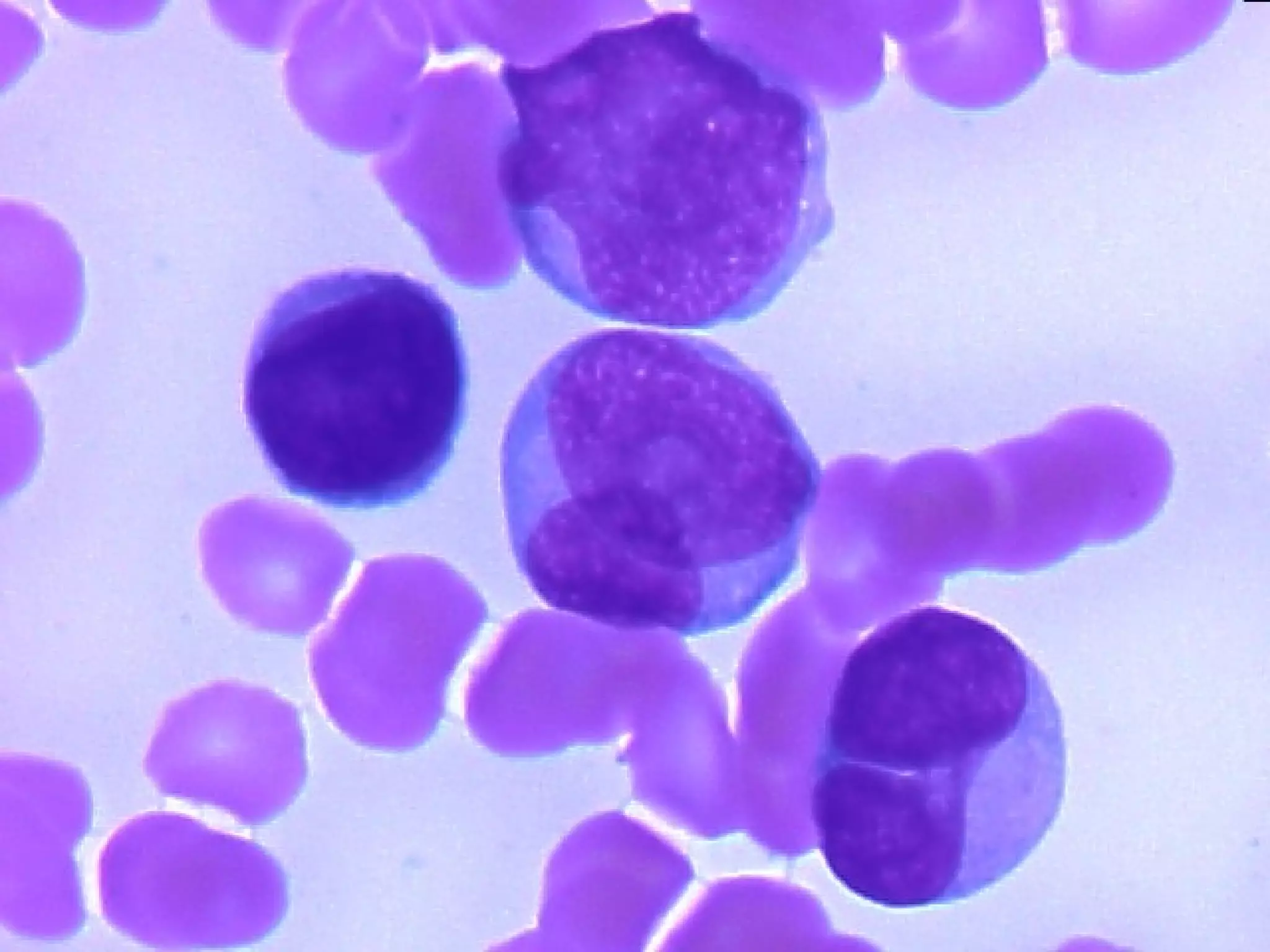 Acute leukaemias classification | PPT