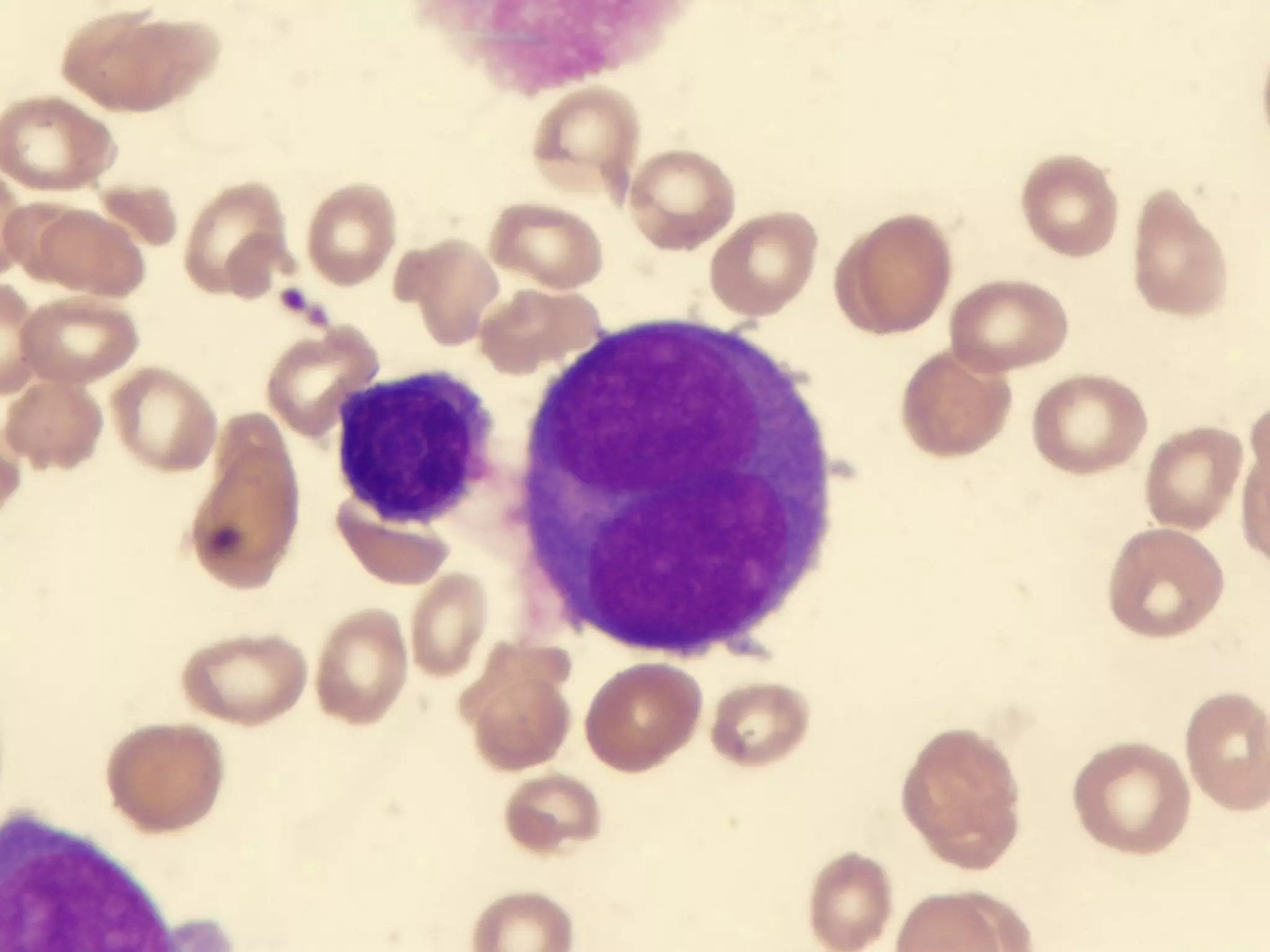 Acute leukaemias classification | PPT