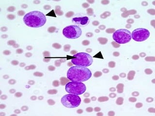 Acute leukaemias classification | PPT