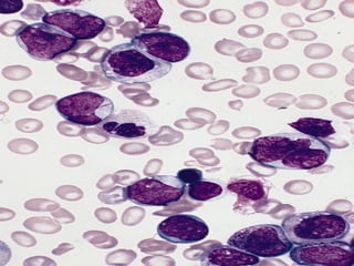 Acute leukaemias classification | PPT