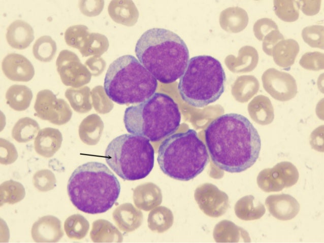 Leukemia Promyelocytic Acute Leukemia Myeloid Acute M3 Leukemia