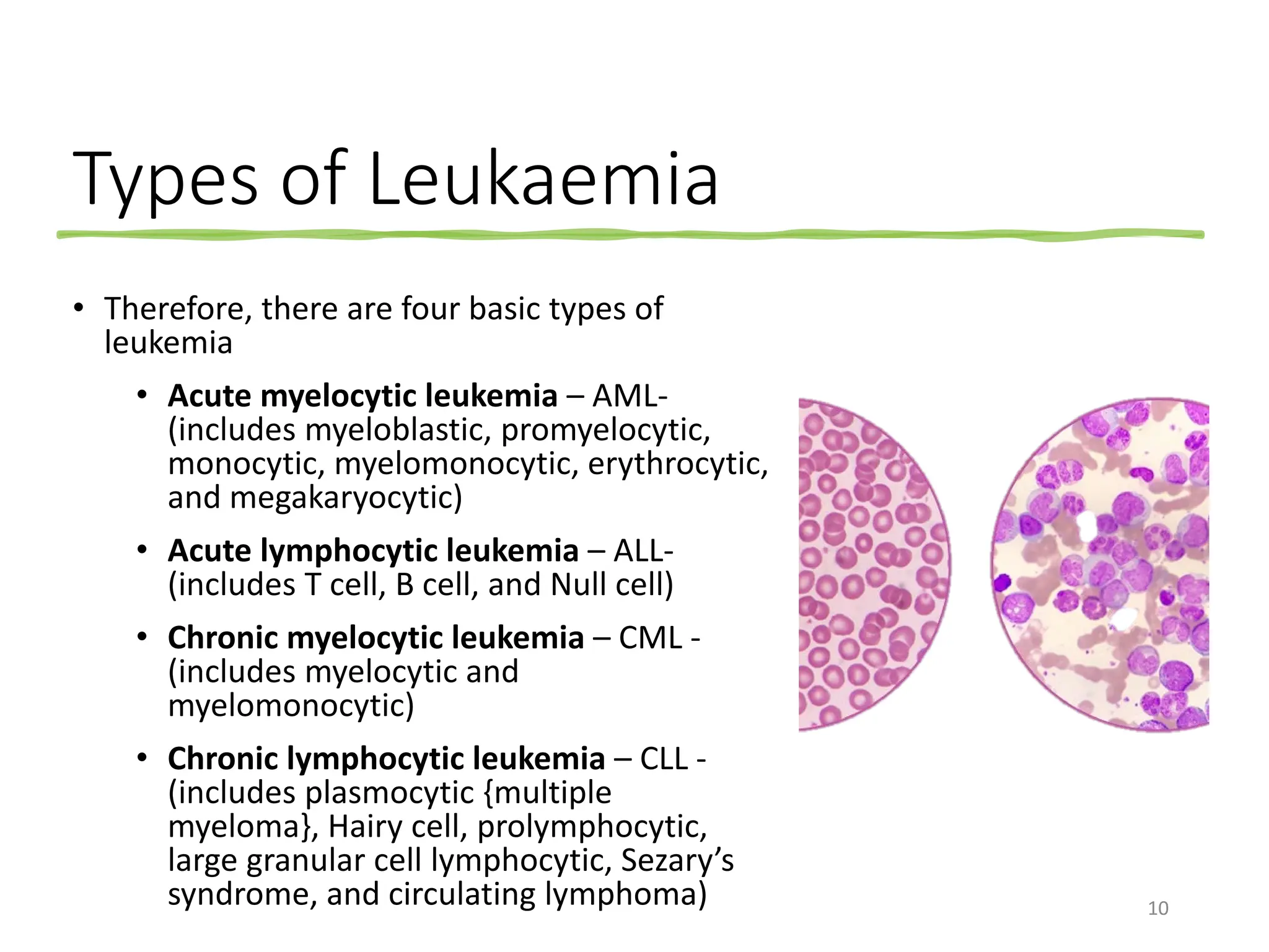 ACUTE LEUKAEMIA IN MYELOCYTIC AND LYMPHOCYTIC LINEAGE .pdf