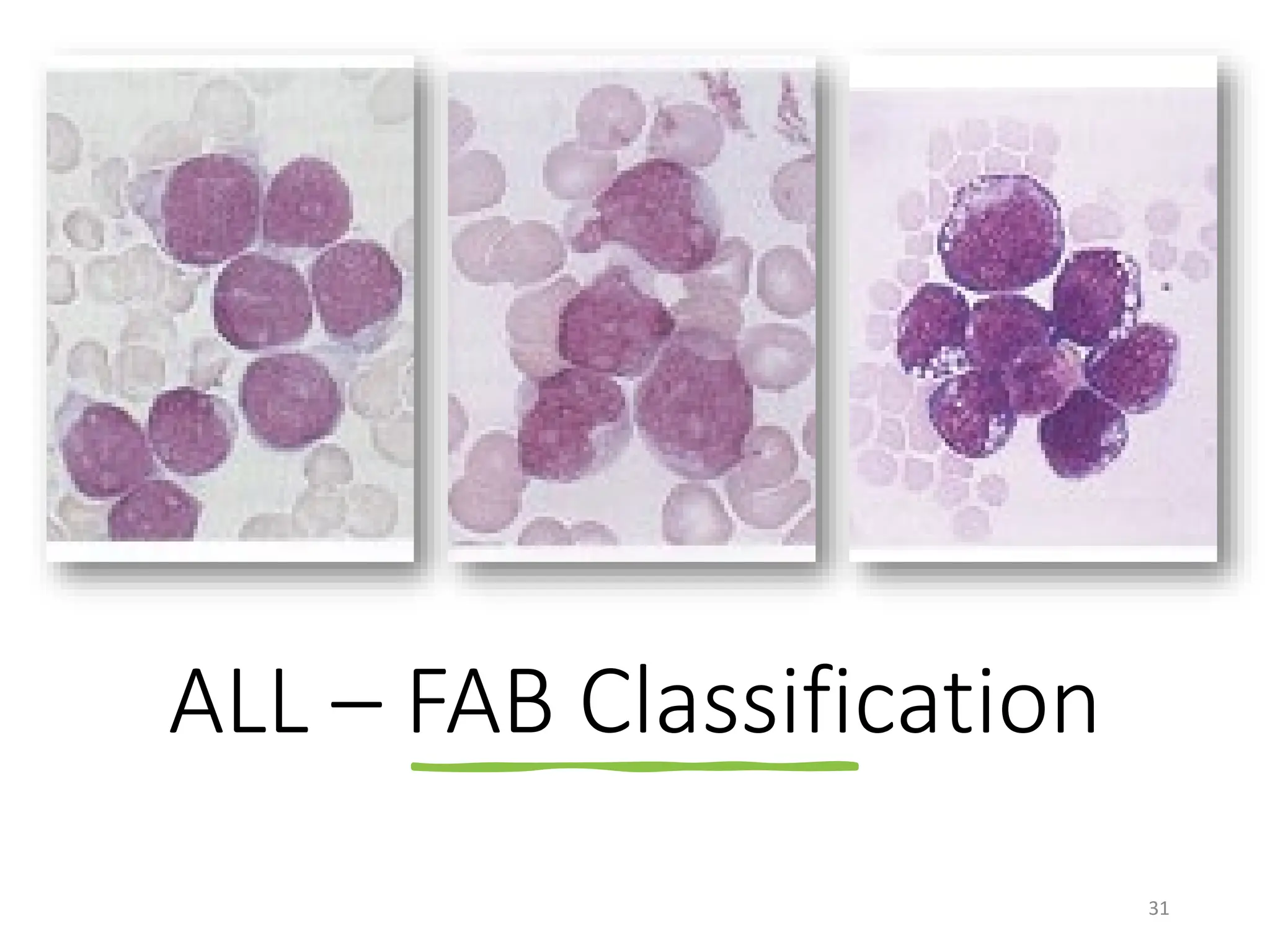 ACUTE LEUKAEMIA IN MYELOCYTIC AND LYMPHOCYTIC LINEAGE .pdf