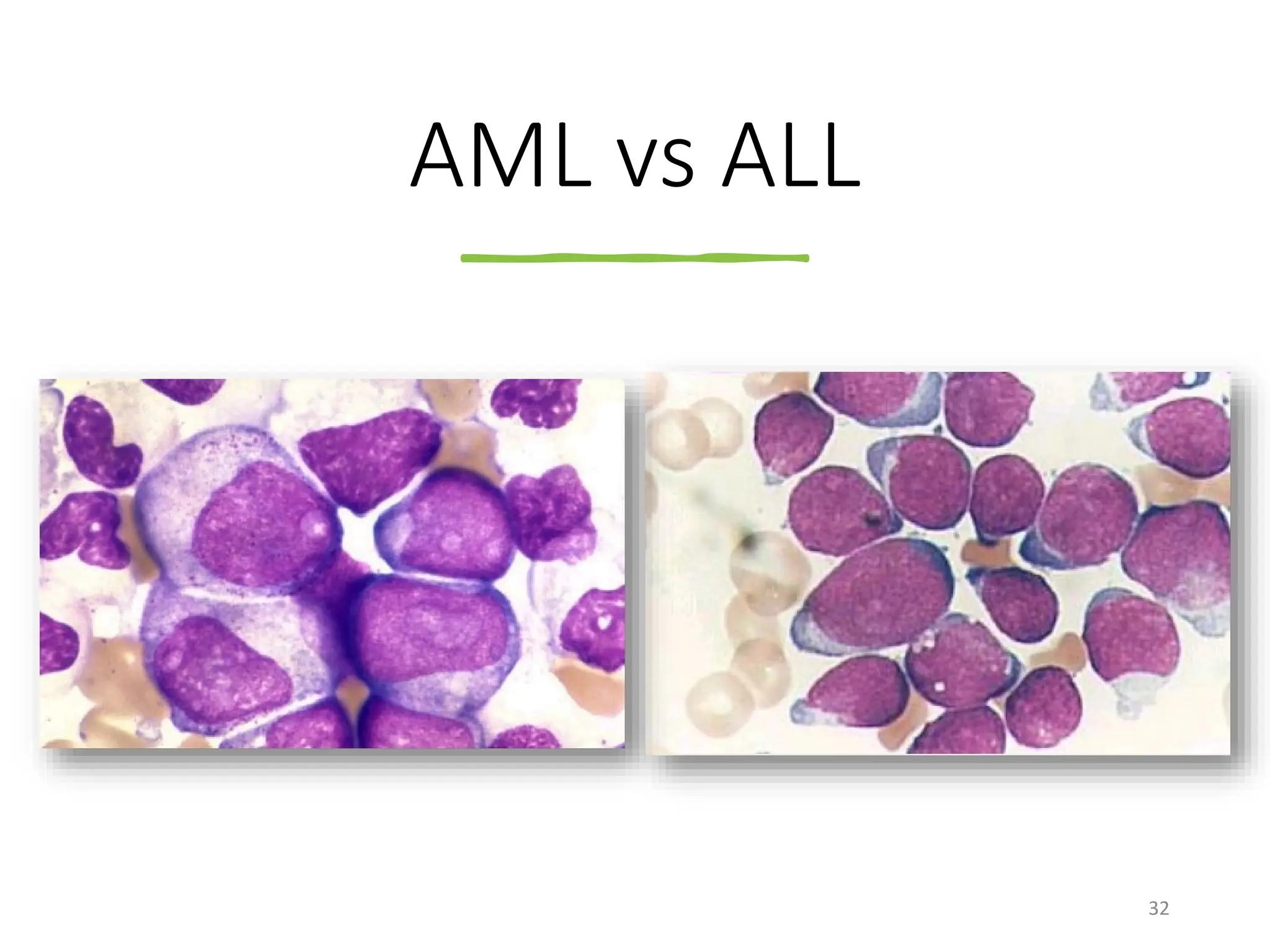 ACUTE LEUKAEMIA IN MYELOCYTIC AND LYMPHOCYTIC LINEAGE .pdf