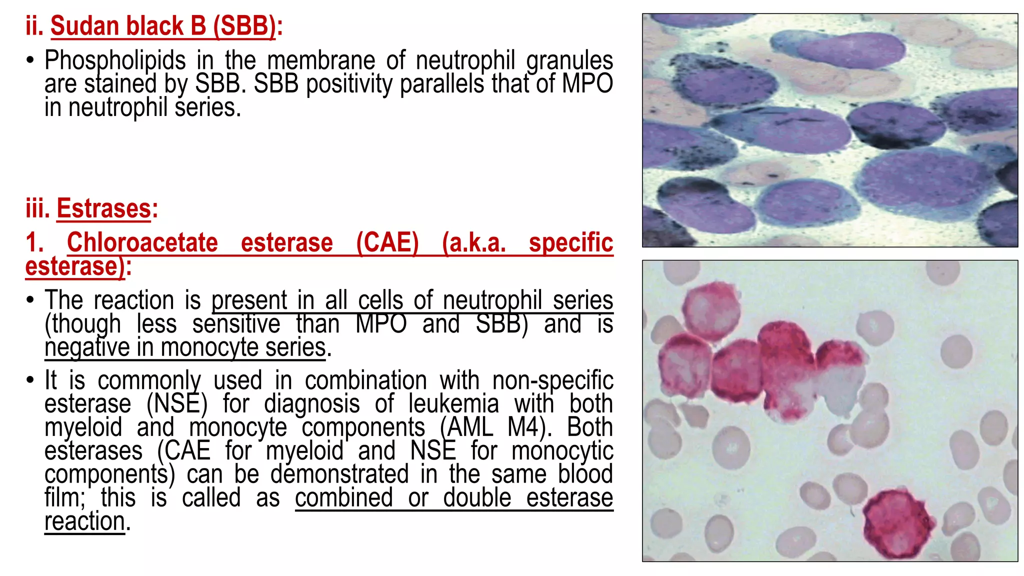 Overview to Diagnosis of Acute leukemia | PDF