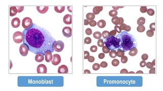 Overview to Diagnosis of Acute leukemia | PDF