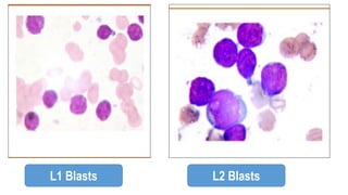 Overview to Diagnosis of Acute leukemia | PDF