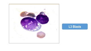 Overview to Diagnosis of Acute leukemia | PDF