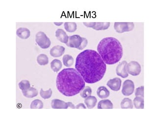 ACUTE LEUKEMIA.ppt