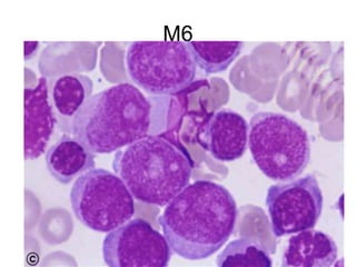 ACUTE LEUKEMIA.ppt