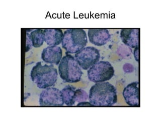 ACUTE LEUKEMIA.ppt