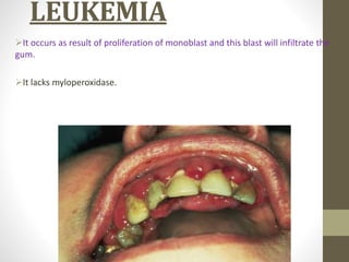 ACUTE LEUKEMIA.pptxsalah.pptx111111111111111 | PPT