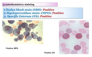 Acute leukemia -AML-ALL.ppt