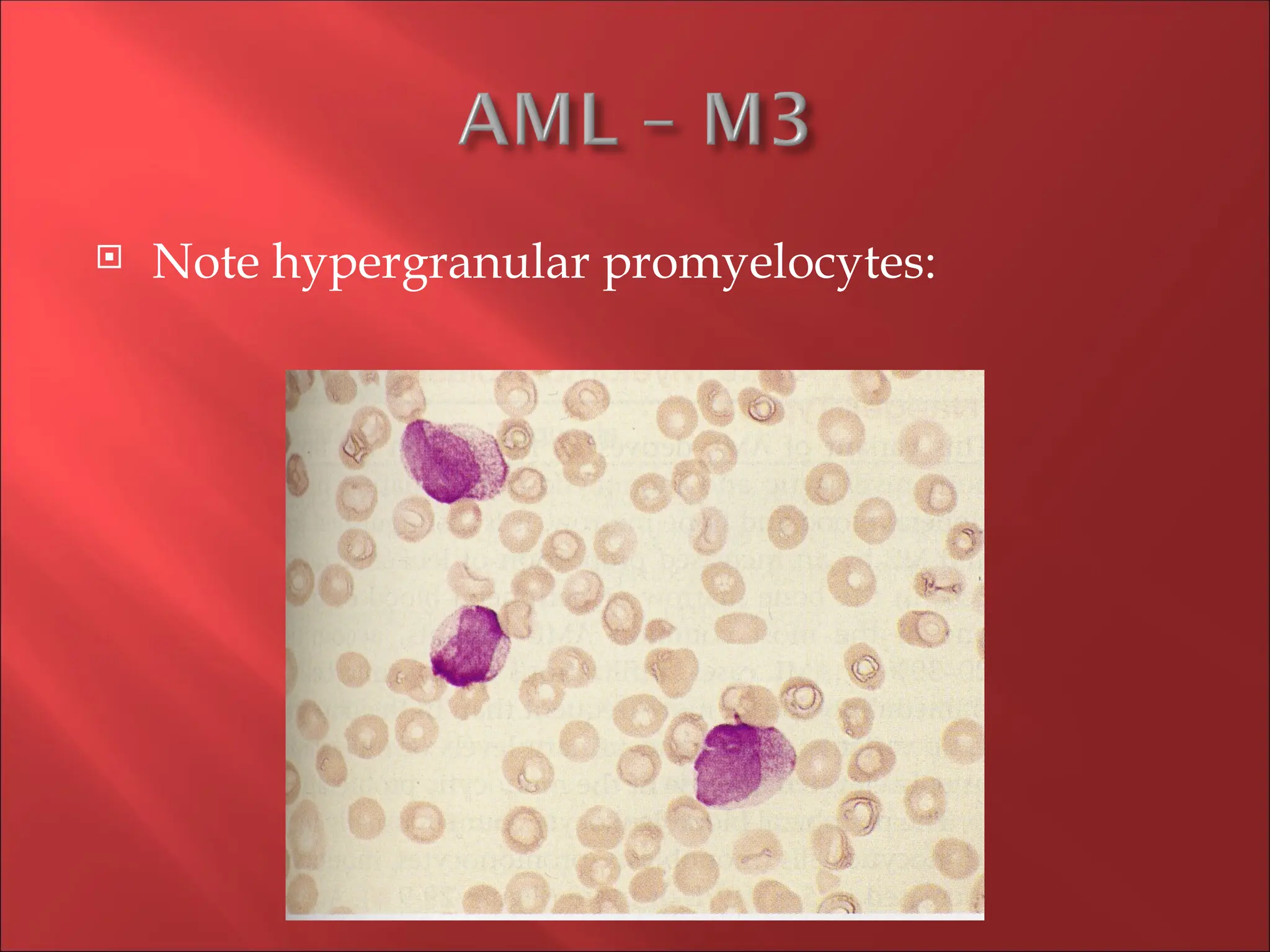 Acute leukemia-acute leukemia Irina.ppt