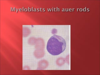Acute leukemia-acute leukemia Irina.ppt