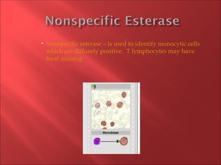 Acute leukemia-acute leukemia Irina.ppt