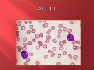 Acute leukemia-acute leukemia Irina.ppt