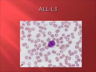 Acute leukemia-acute leukemia Irina.ppt