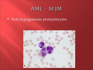 Acute leukemia-acute leukemia Irina.ppt