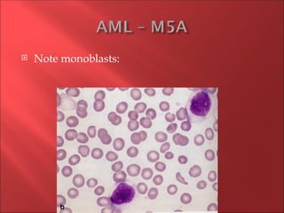 Acute leukemia-acute leukemia Irina.ppt
