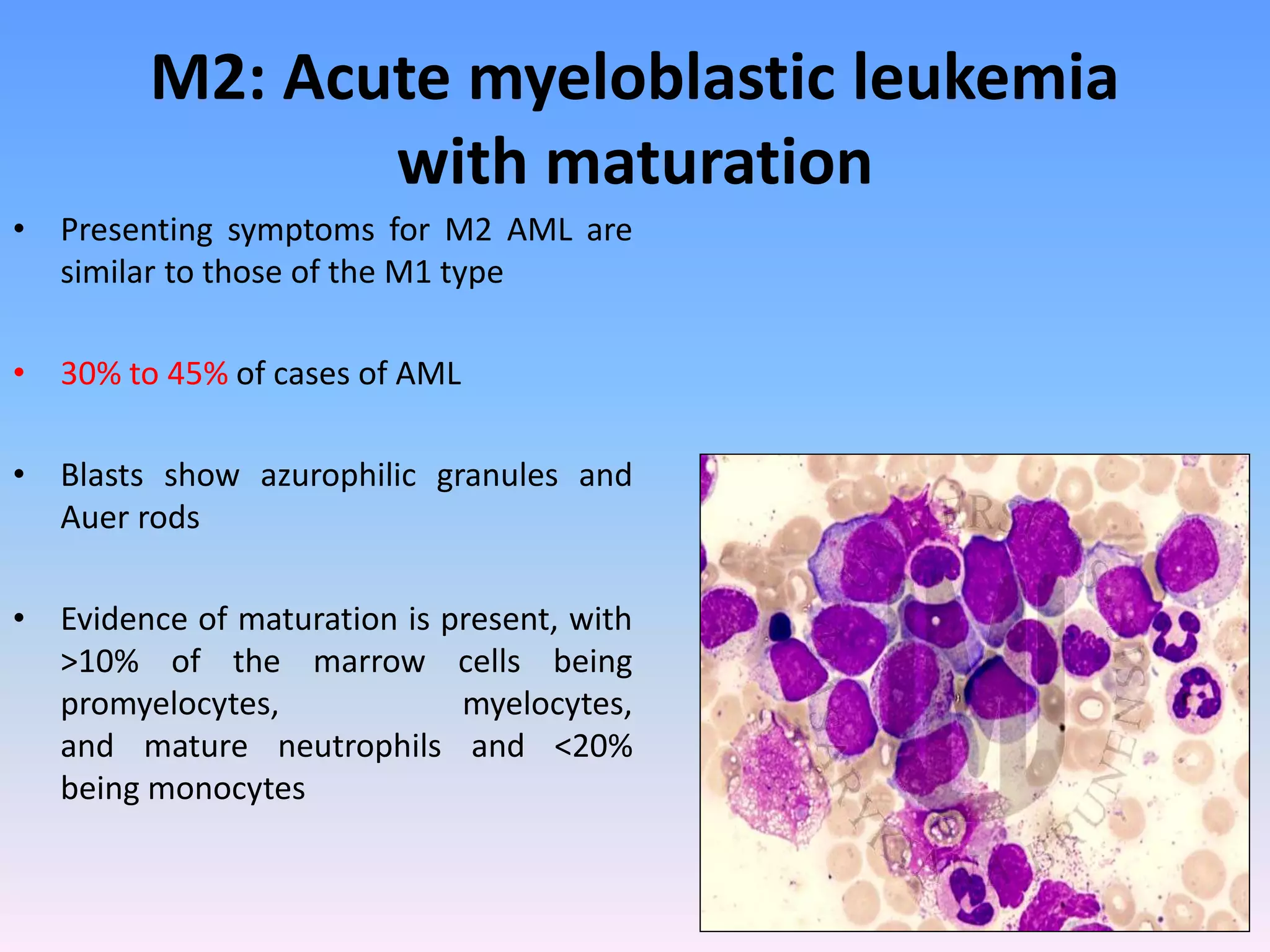 Acute leukemia | PPTX