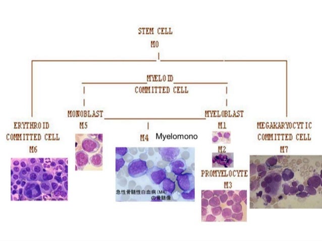 Acute Myeloid Leukemia Stages