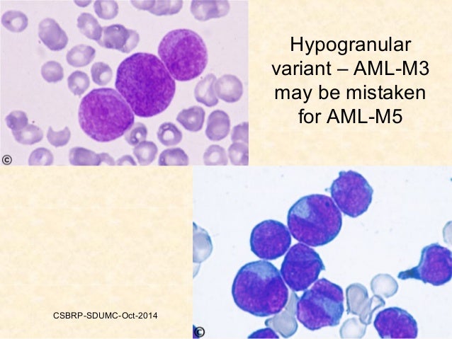 Acute leukemias 1-csbrp