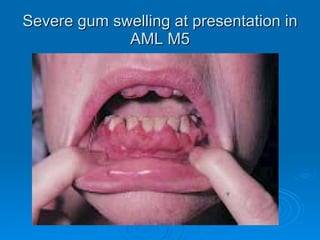 medicine.Acute leukemias.(dr.sabir) | PPT