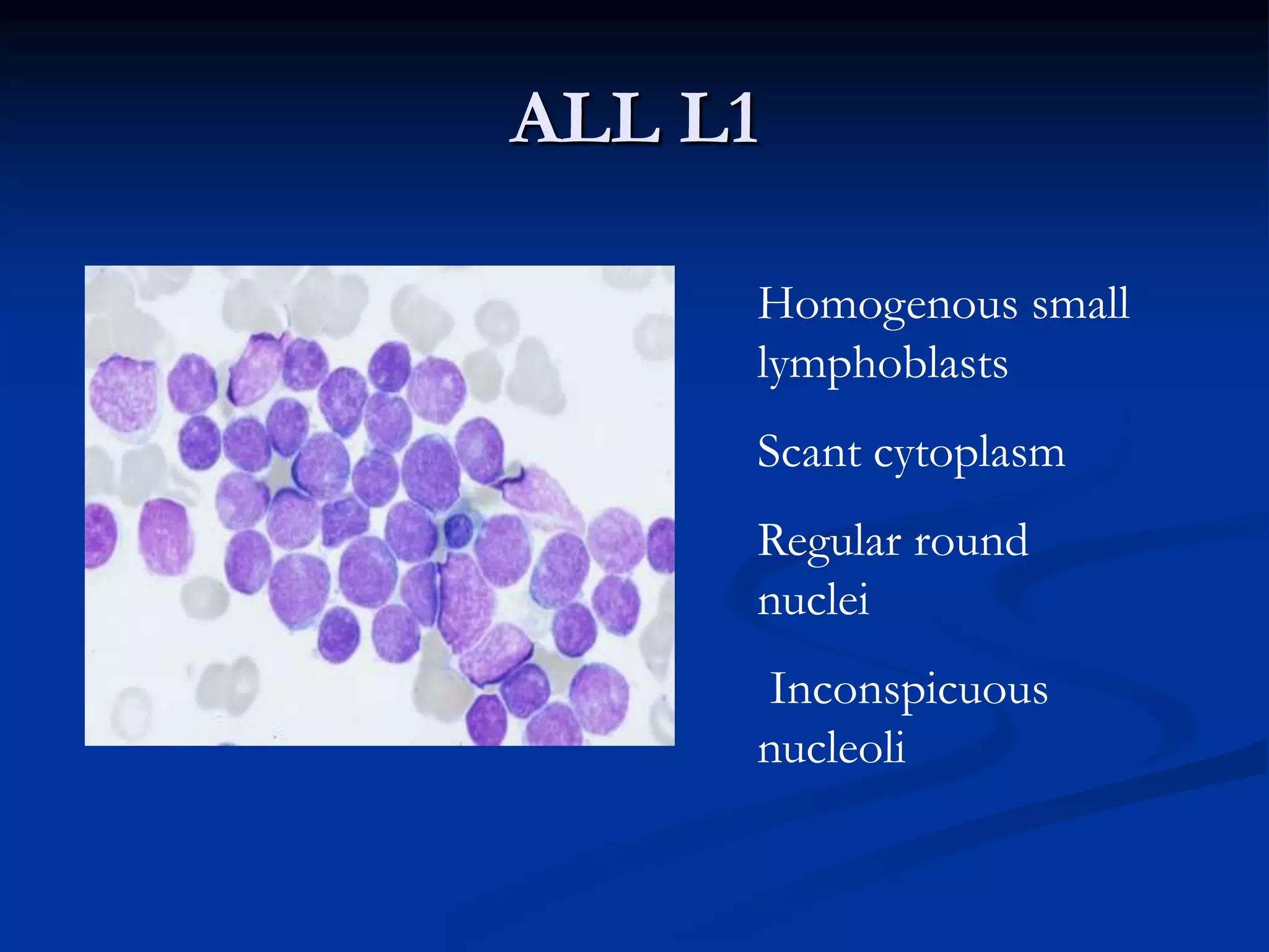Acute leukemias | PPTX