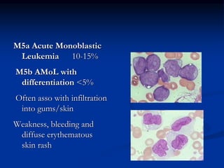 Monoblastic Leukemia