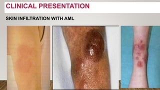 Acute Leukemias by Dr. Sookun Rajeev Kumar | PPT