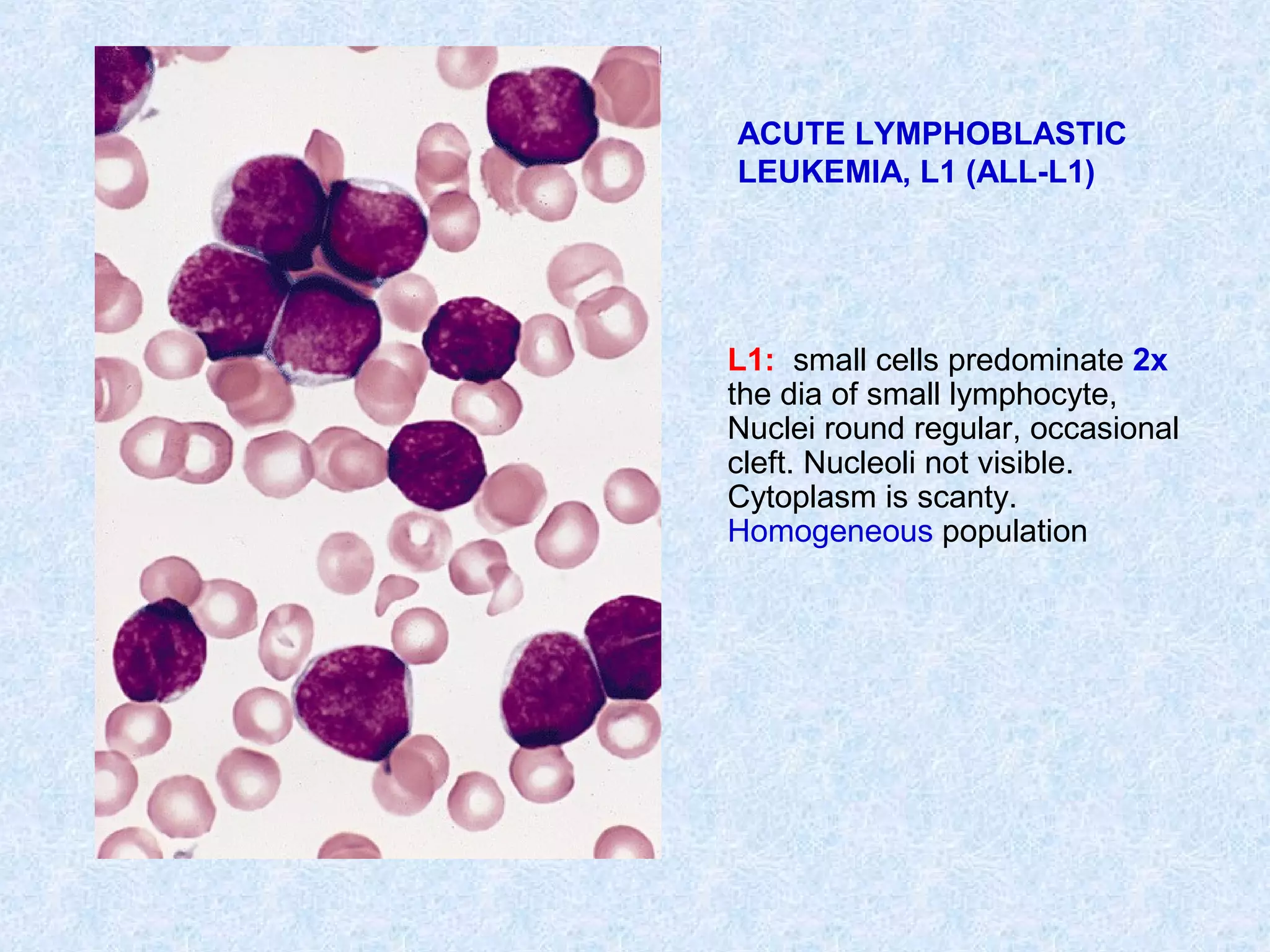 Acute leukemias 2-csbrp | PPT