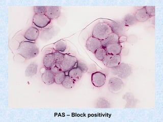 Acute leukemias 2-csbrp | PPT | Blood Disorders | Diseases and Conditions