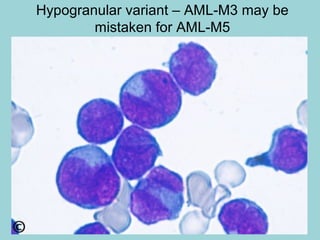 Acute leukemias aml-csbrp | PPT