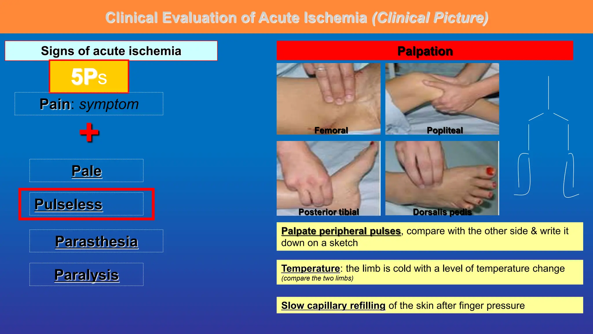 Diagnosis and management of Acute limb -ischemia (1).ppt