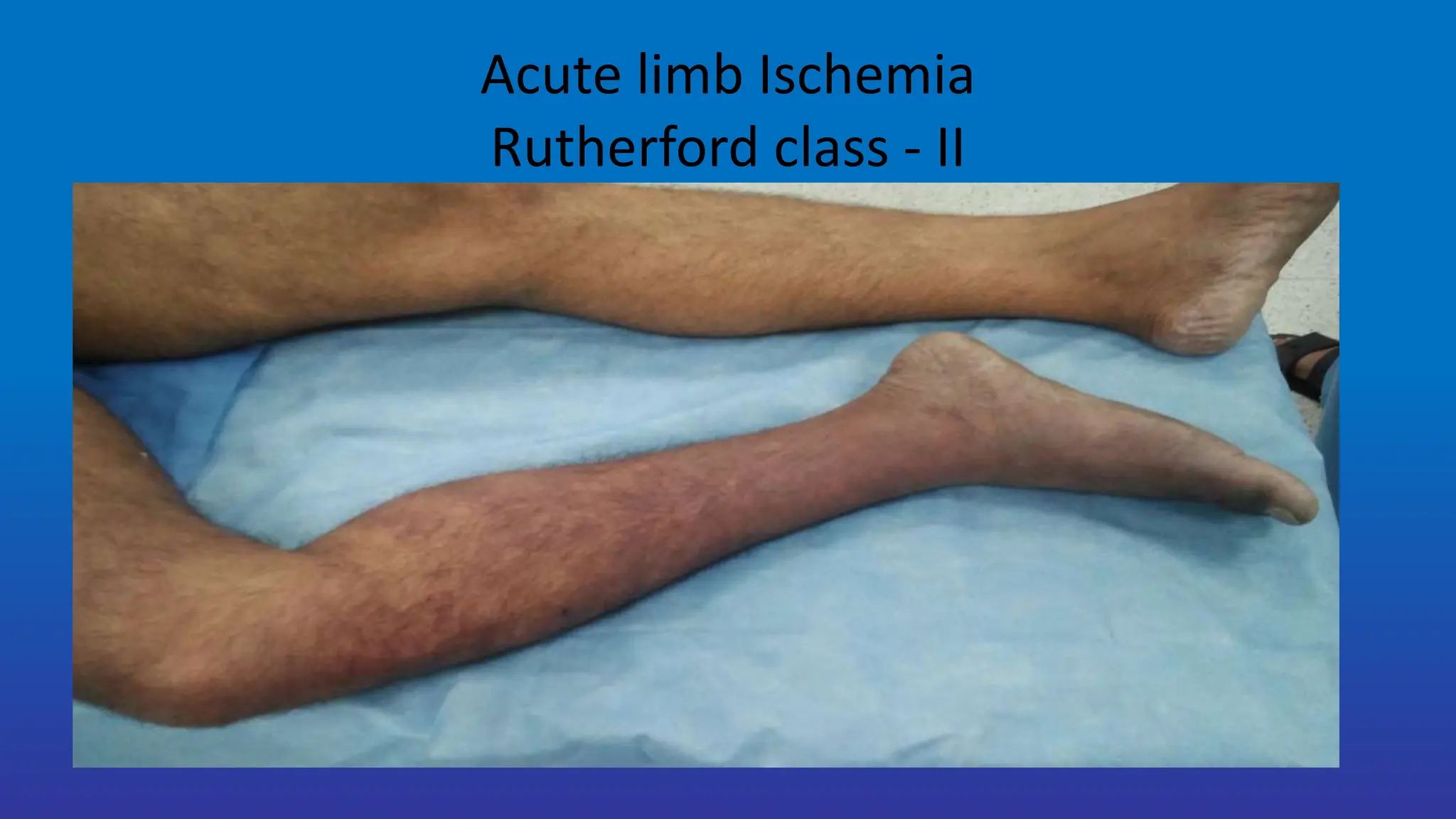 Diagnosis and management of Acute limb -ischemia (1).ppt