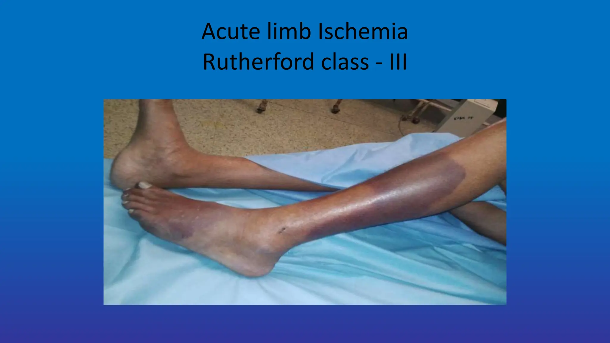 Diagnosis and management of Acute limb -ischemia (1).ppt