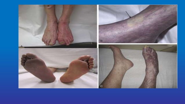 Diagnosis and management of Acute limb -ischemia (1).ppt