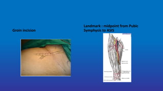 Diagnosis and management of Acute limb -ischemia (1).ppt