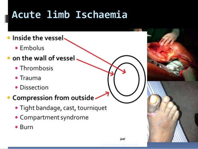 Acute limb ischaemia