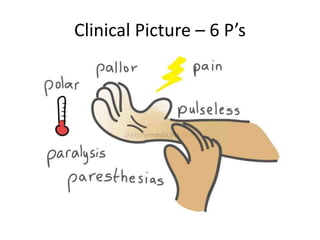 Acute limb ischaemia | PPTX