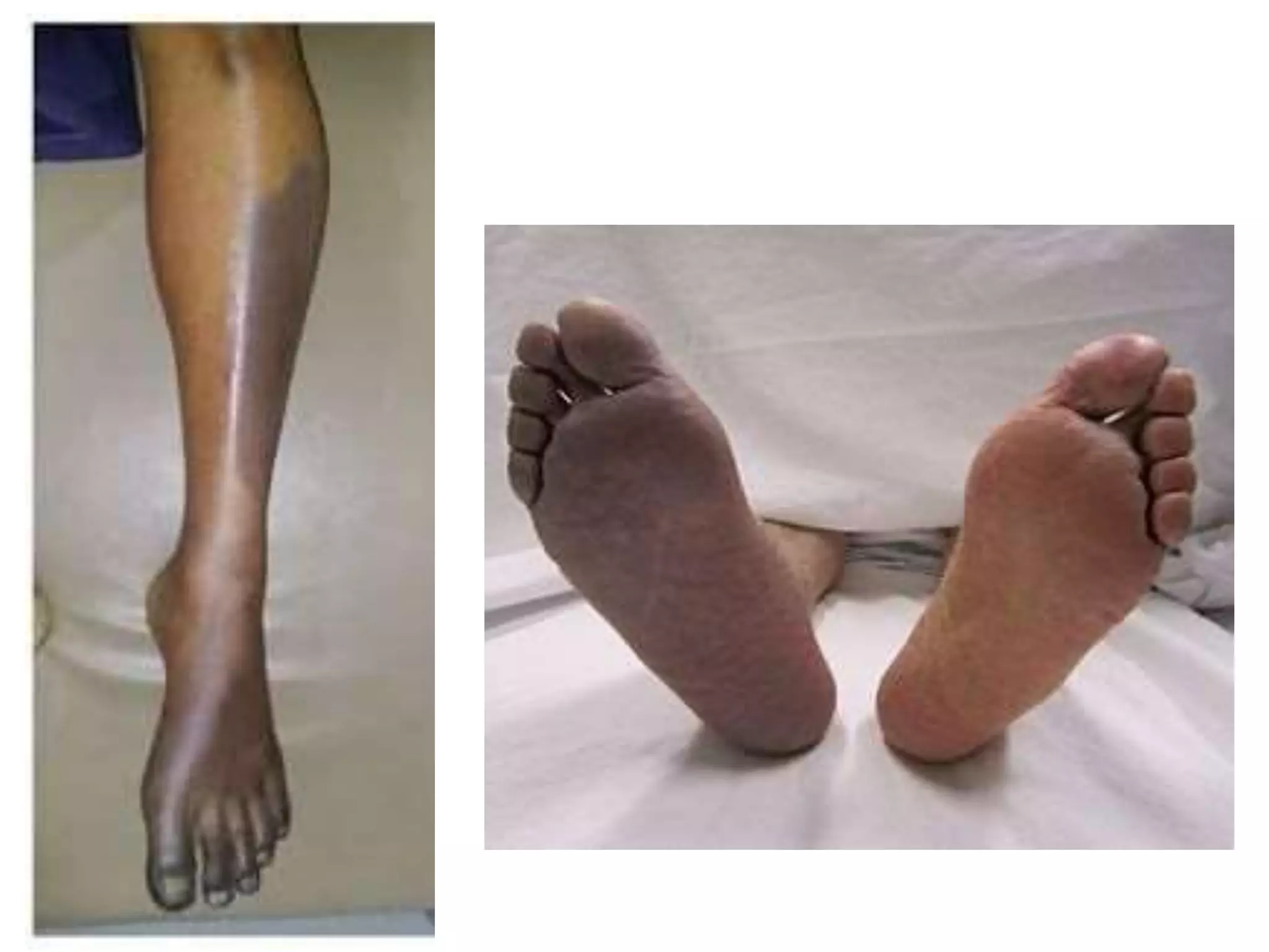 Acute limb ischaemia | PPTX